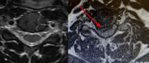 Estenose Cervical – Dr. Lucas Franco